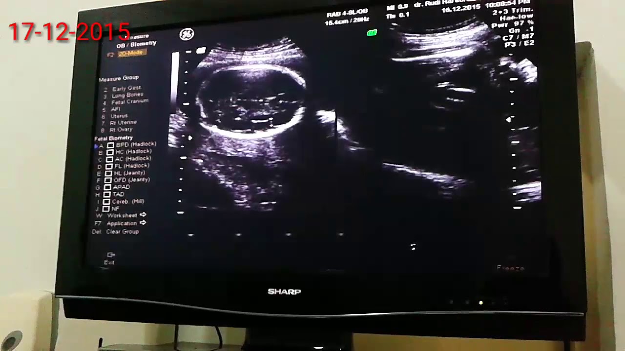 USG 6 bulan 4 dimensi - YouTube