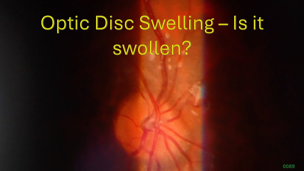 0089: Optic Disc Swelling - Is it Swollen? - YouTube