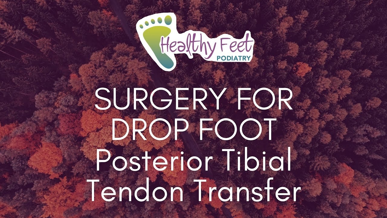 Posterior Tibial Tendon Transfer Surgery for Drop Foot . Drop foot ...