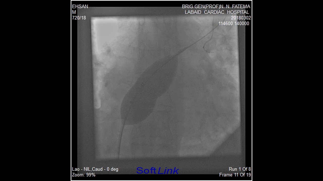 Baby Eashan 06 Yrs 25 Kg Large ASD II Balloon Sizing Angio show - YouTube