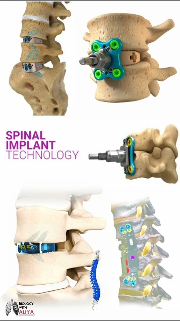 Surgical Device_ Medical Animation_ Prism Surgical - AQUILA-BOREALIS ...