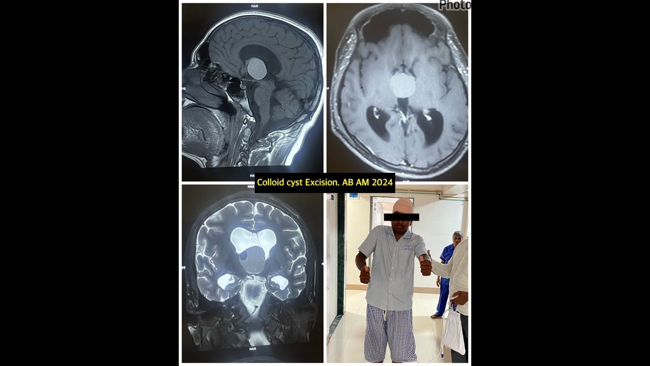 Colloid cyst | Third ventricular brain tumor | Neurosurgery| Brain ...
