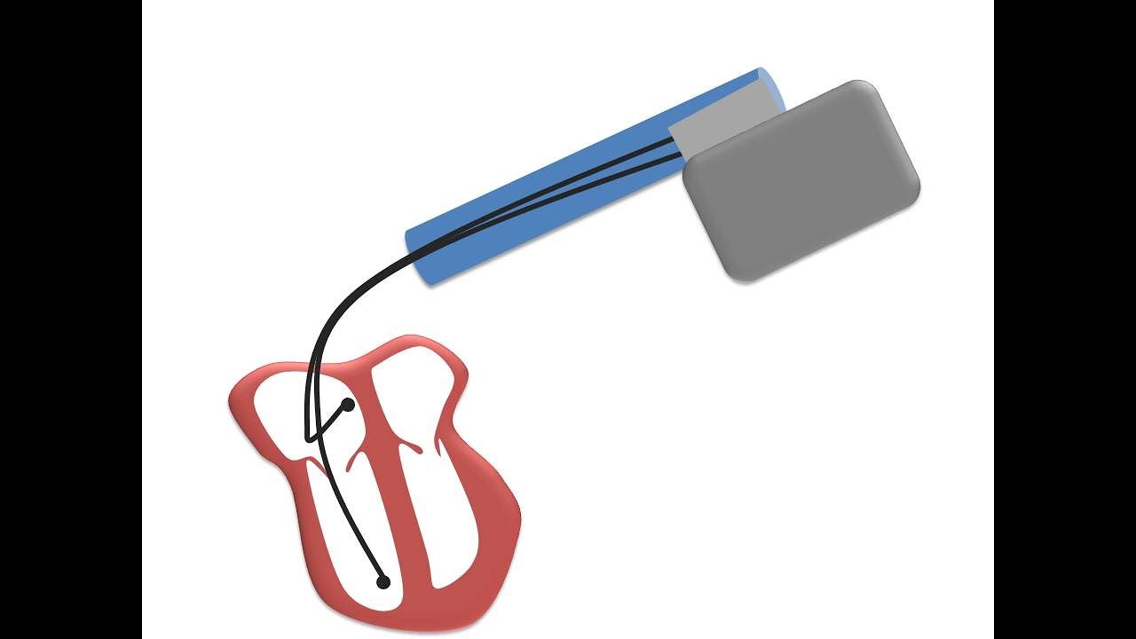 ESC Guidelines, Device Implantation - YouTube