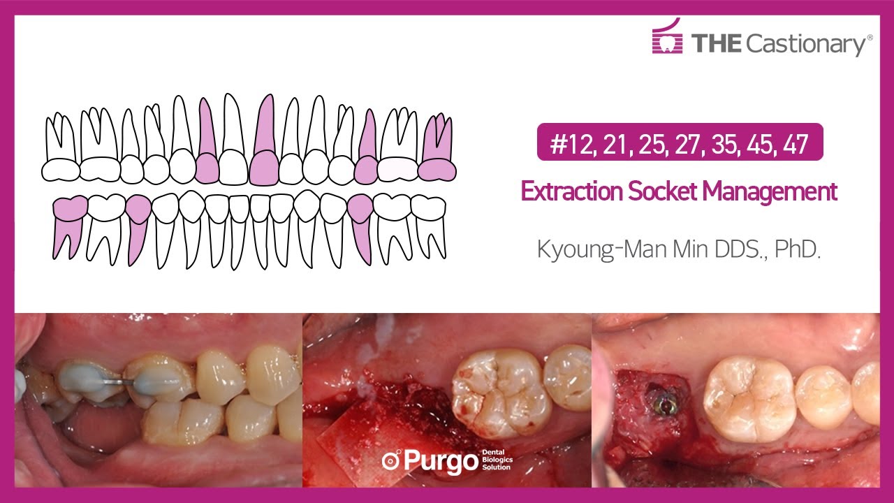[#12, 21, 25, 27, 35, 45, 47] Extraction Socket Management - YouTube