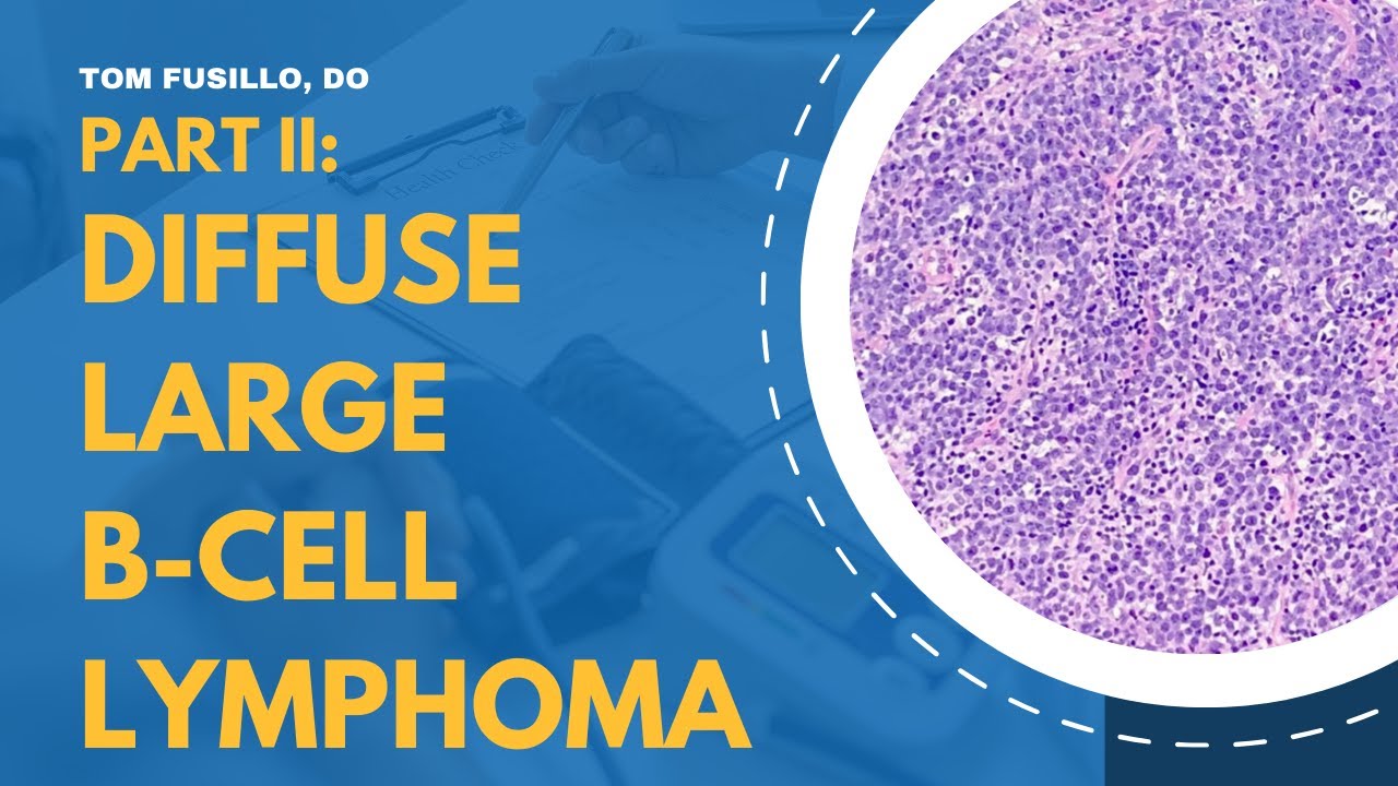 Diffuse Large B-Cell Lymphoma | Part 2: Treatment | R-CHOP, O-CHOP, DA ...