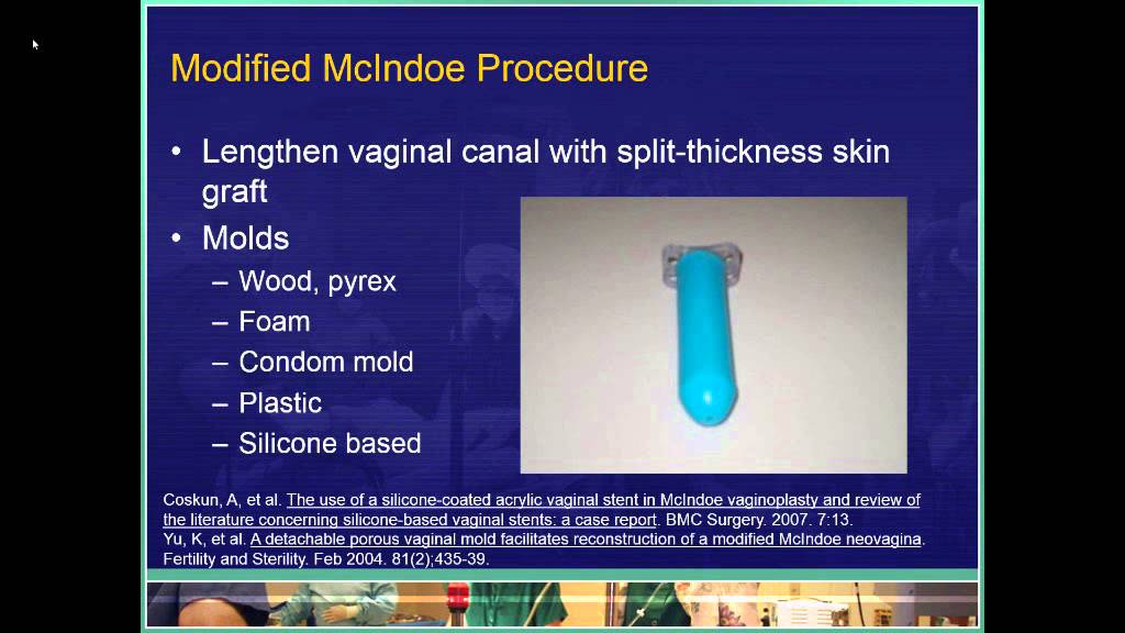 Modified McIndoe procedure (part 1) - YouTube
