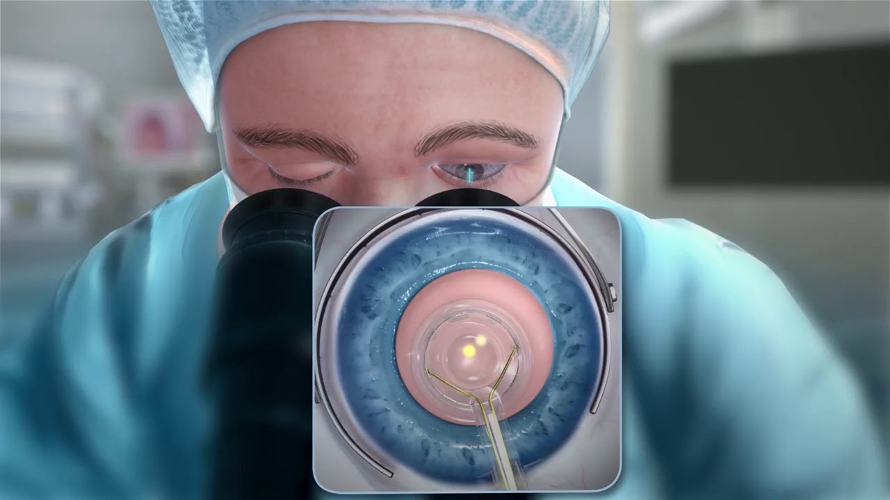 Zepto™ Capsulotomy System - YouTube