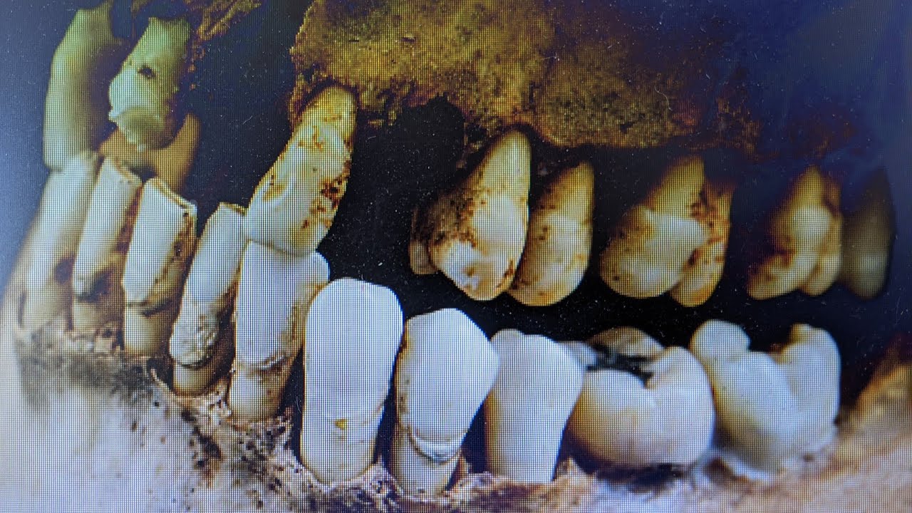 My Dental Nightmare in the Philippines - YouTube