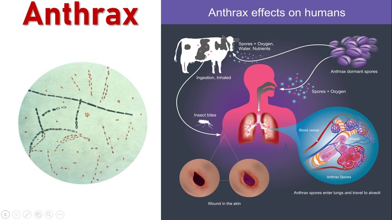 Anthrax: Symptoms, Diagnosis, Treatment & Prevention | Bacillus ...