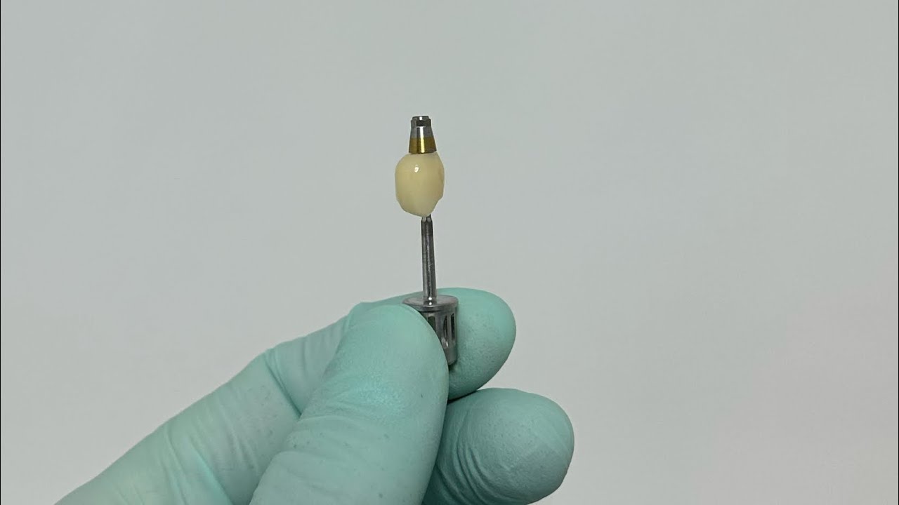 Coroana dentara intr-o zi: extractie, implant, coroana temporara - YouTube