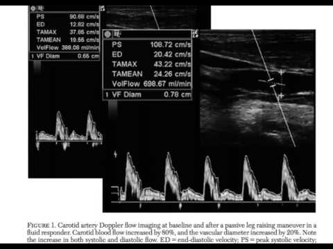 Ultrasound Podcast - CAROTID VTI PASSIVE LEG RAISE FOR VOLUME ...