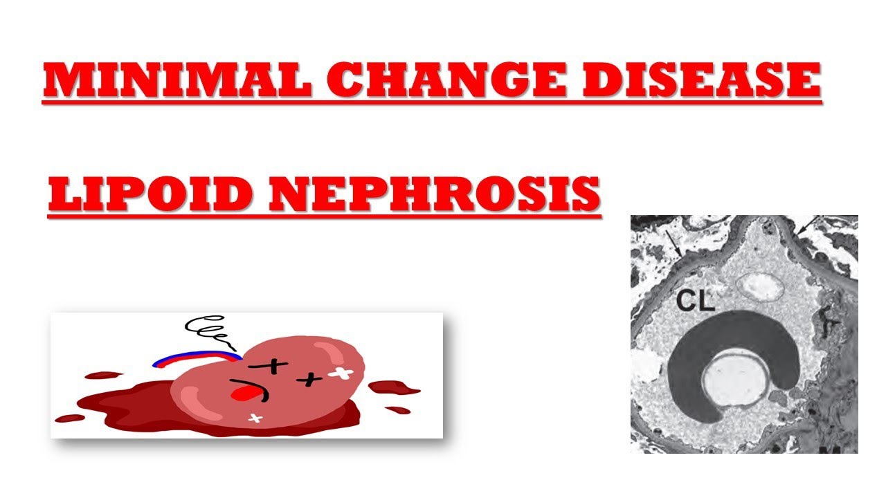 Minimal Change Disease | Nephrotic Syndrome | Lipoid Nephrosis ...