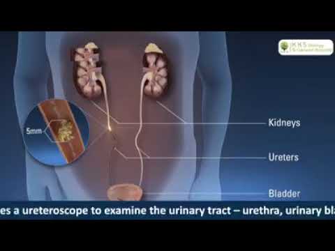 LASER URS Technique | K K S Urology & General Hospital Jaipur - YouTube