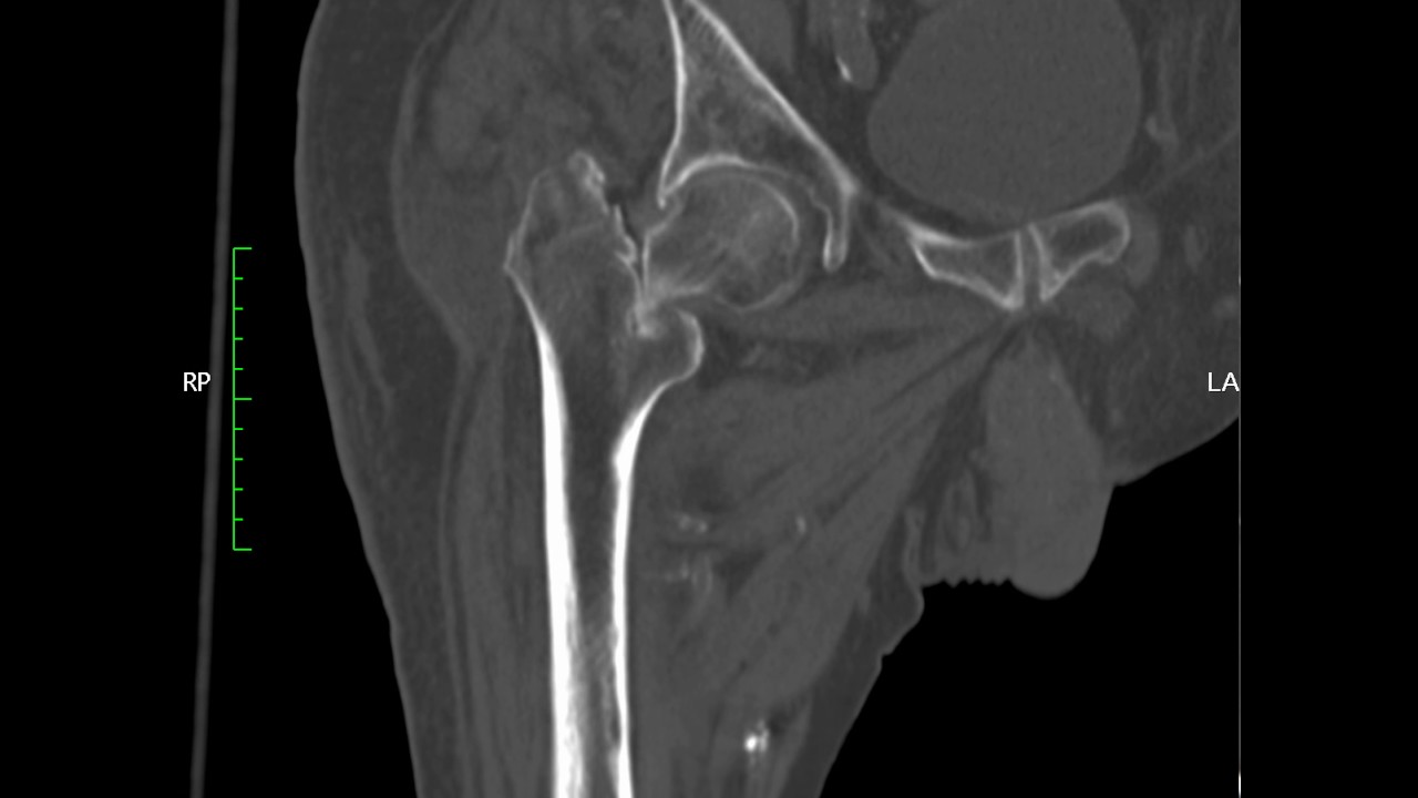 Femur Ct - YouTube