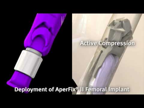 Fast AperFix II Animation - YouTube