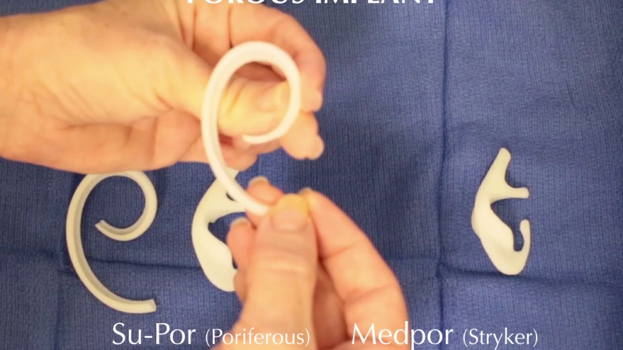 Porous Implants for Microtia Ear Reconstruction: Su-Por vs Medpor - YouTube