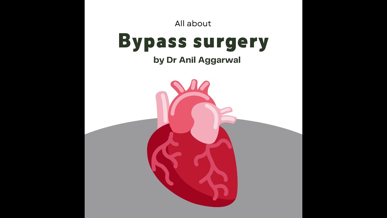 All About Bypass Surgery Procedure by Dr Anil Aggarwal - YouTube