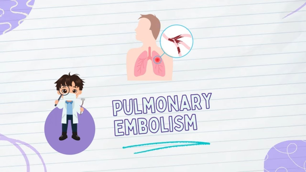 Pulmonary embolism: Pathophysiology, Types, diagnosis, & Treatment ...