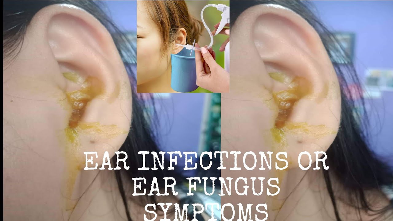 SYMPTOMS OF EAR INFECTIONS | EAR FUNGUS | NANA SA LOOB NG TAINGA ANO ...