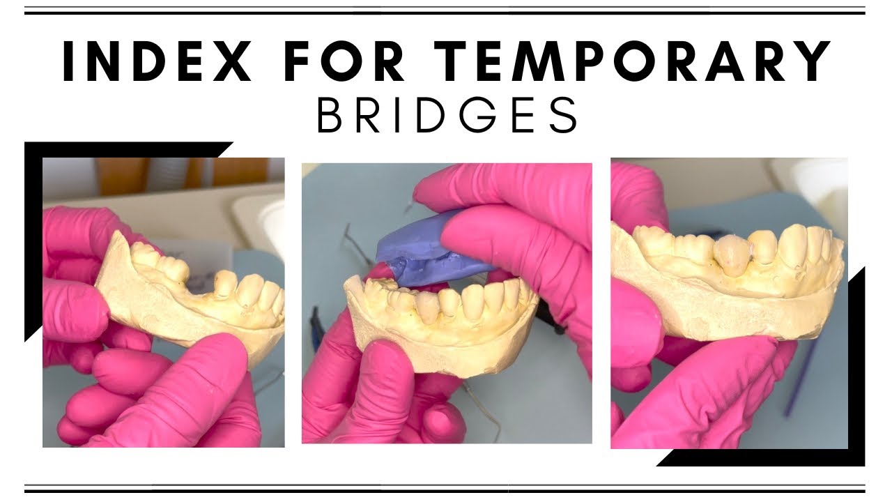 DENTAL MOCK UP // TEMPORARY BRIDGES // PART 1 // Dental Assistant - YouTube