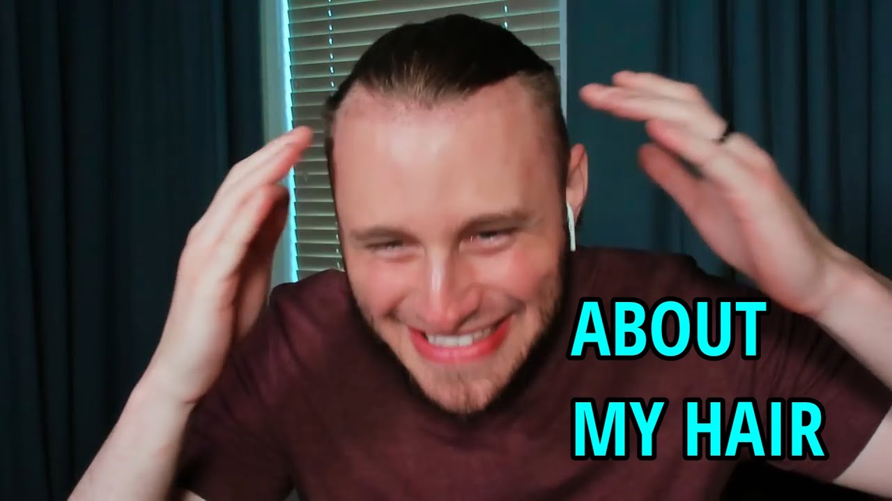 SSundee tells about his hair transplant - YouTube