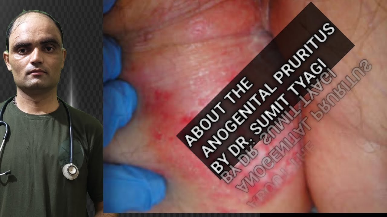 ABOUT THE ANOGENITAL PRURITUS BY DR.SUMIT TYAGI@SUMITMEDICALDISPENSARY1 ...