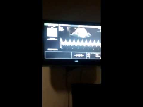 Our baby boys Heart Beat 152(: - YouTube