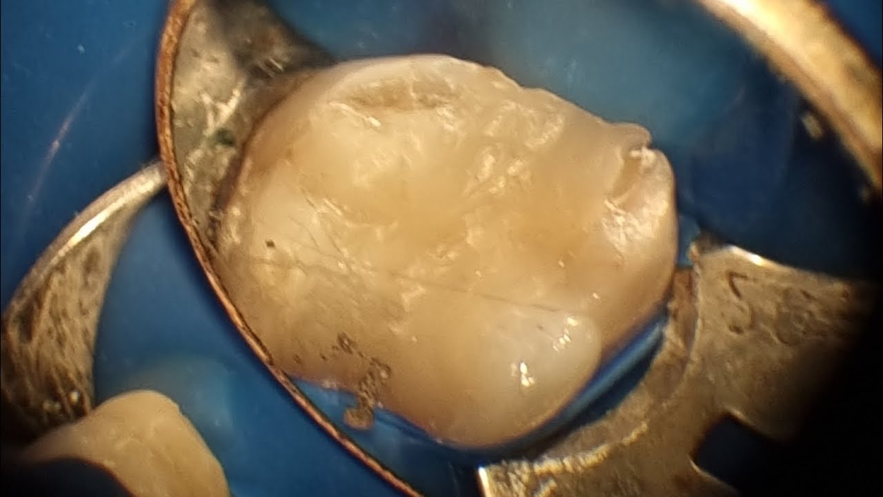 dente 16 - restauração de infiltrações cariosas em restauração de ...