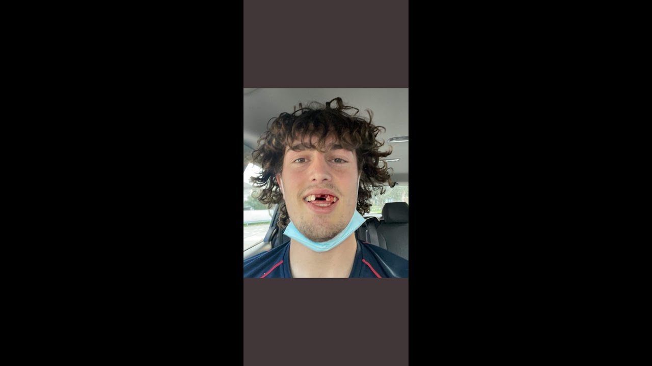 Luke Jackson looses his tooth | Melbourne vs Brisbane Qualifying Final ...