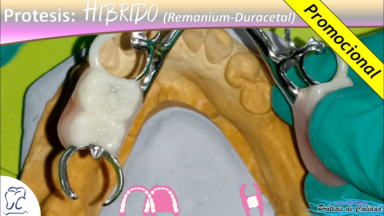 Prótesis: Híbrida (Remanium-Duracetal) Caso 03 - YouTube