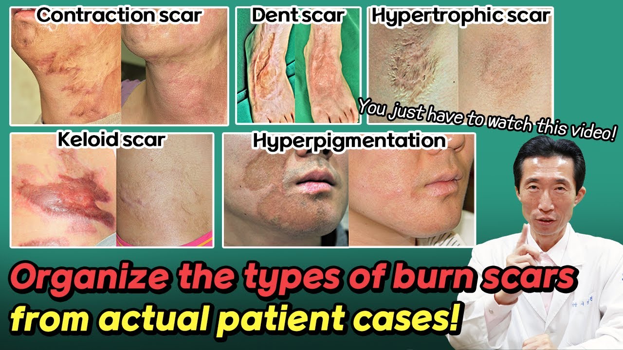 No matter how many different burn scars you have, you can treated ...