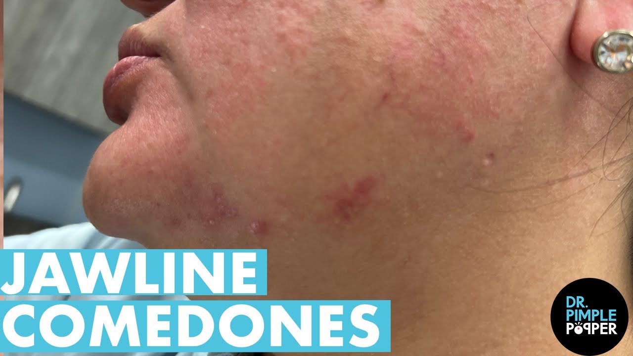 Pinching & Extracting Jaw Comedones Part 1! Dr Pimple Popper Satifies ...