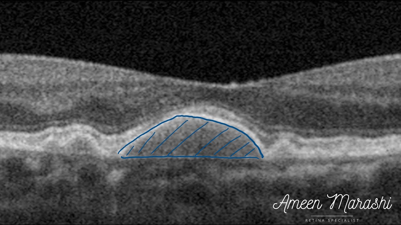 Course in clinical applications of OCT for macular diseases - Non ...