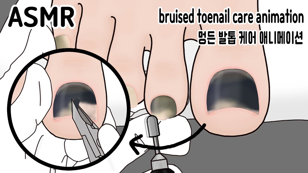 [ASMR] 아주 까맣게! 피멍든 발톱 케어 / Bruised Toenail Care Animation - YouTube