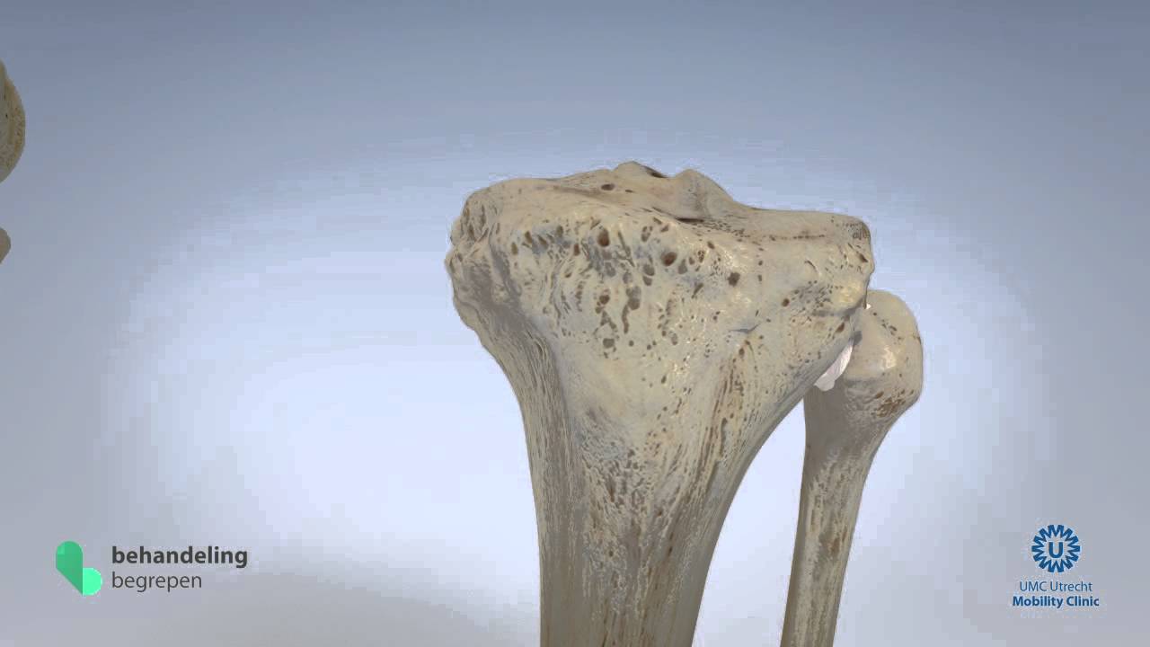 Uitleg behandeling standscorrectie bij artrose, Mobility Clinic - YouTube