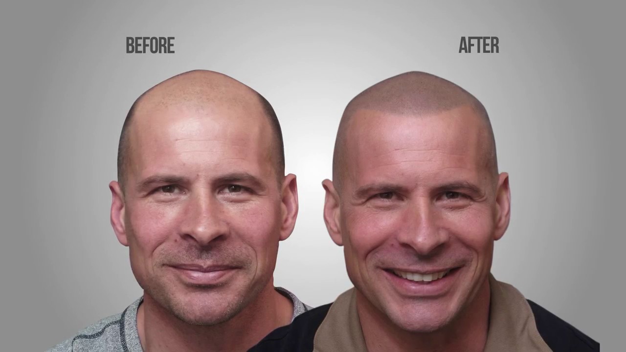 Good Look Ink | Before and After Balding Solutions - YouTube