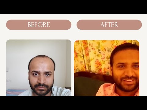 This is My After Hair Transplant surgery video - YouTube