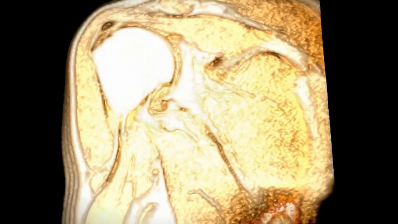 Calcific Tendinitis of The Shoulder - X-ray and MRI Finding - YouTube