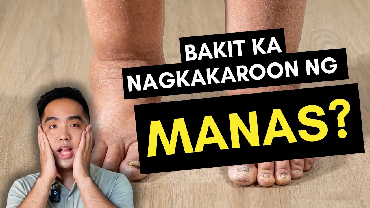 Bakit Nagkakaroon ng Manas? - YouTube