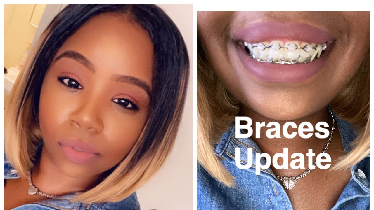 Braces Update !! - YouTube