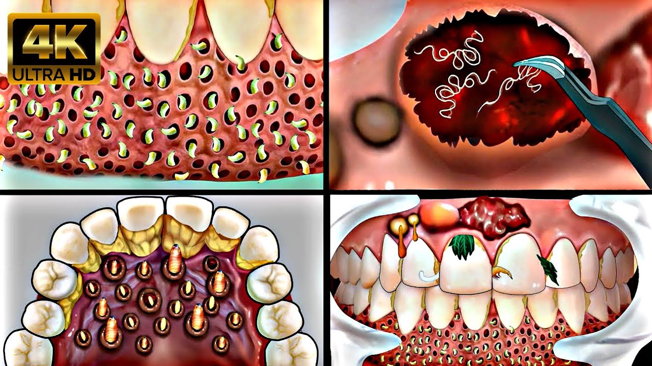 ASMR Remove Botfly Maggots inside Dirty Mouth | Dental care animation ...