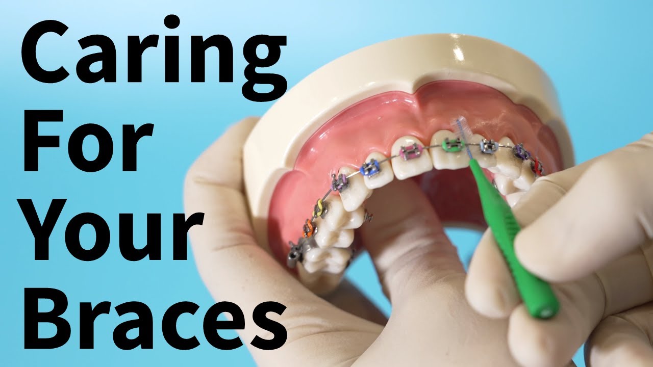 Caring For Your Braces | Dental - YouTube