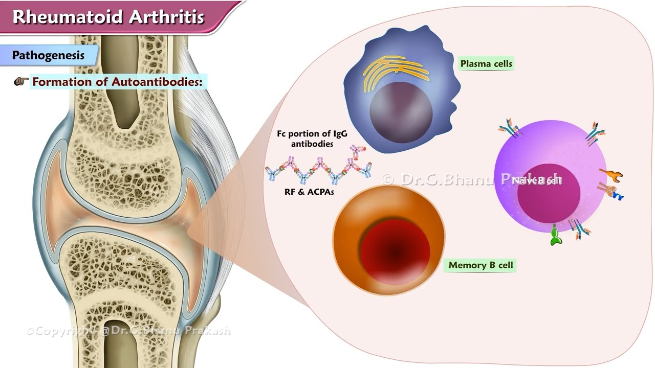 Rheumatoid Arthritis Animation: Etiology , Pathogenesis , Clinical ...