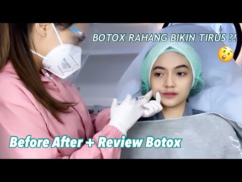PENGALAMAN & REVIEW BOTOX RAHANG + FILLER DI DERMA EXPRESS! (Before ...