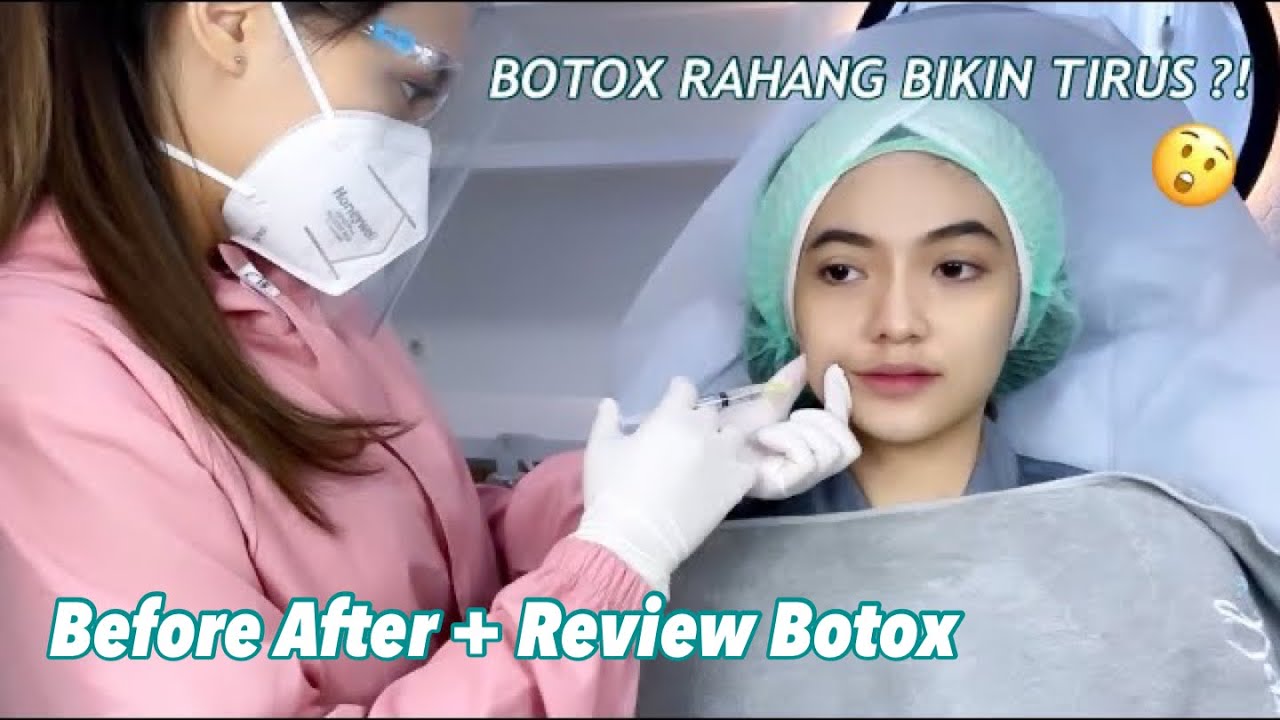 PENGALAMAN & REVIEW BOTOX RAHANG + FILLER DI DERMA EXPRESS! (Before ...