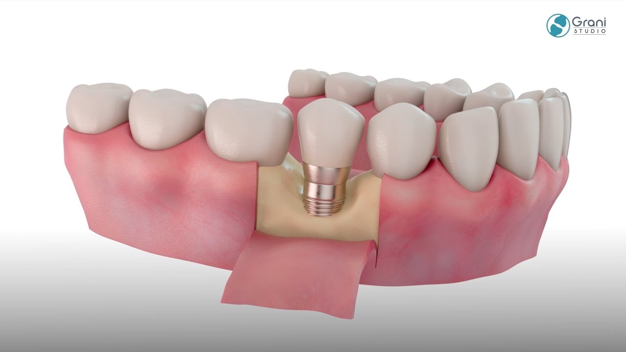 Peri-Implantitis_Dental Animation - YouTube
