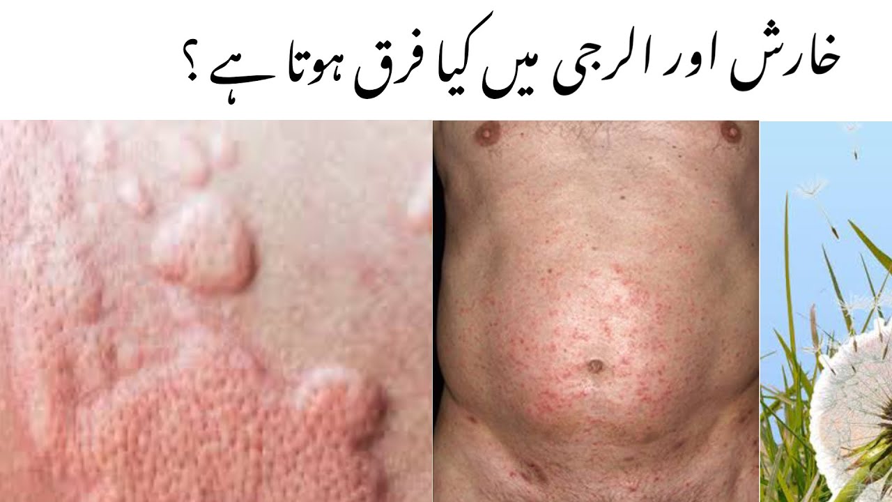 Kharish aur allergy main Kia farq hota hai | medicine info . - YouTube
