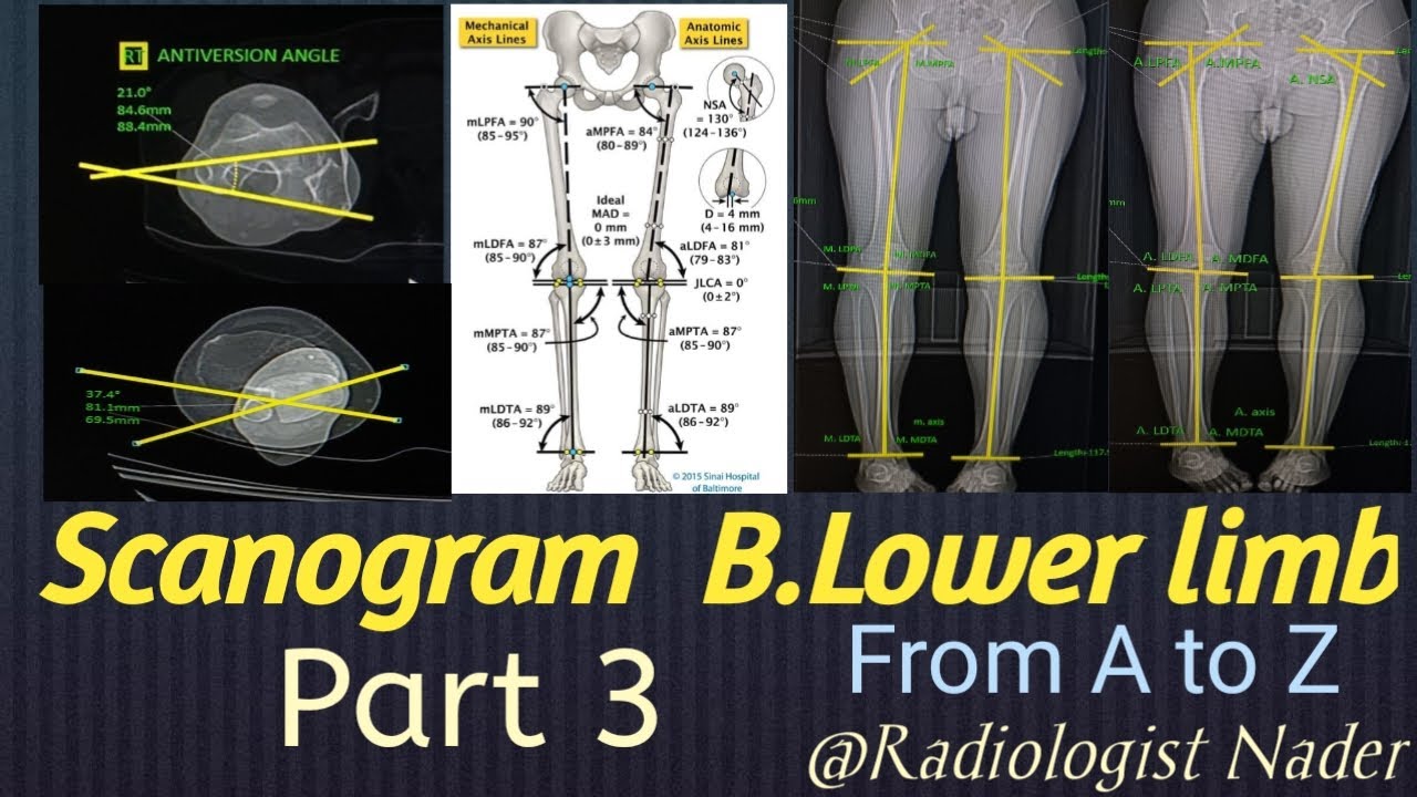 سكانوجرام.الجزء3(المحور التشريحي وزواياه)Scanogram B.lower limb. part 3 ...