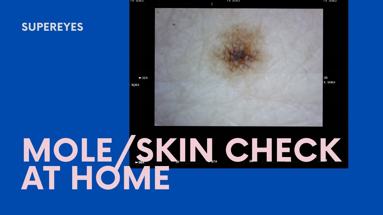 Skin check at home for telemedicine with a digital microscope - YouTube