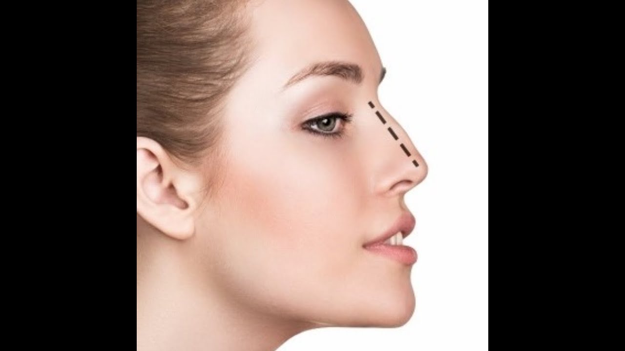 Totul despre deviația de sept nazal: cauze, simptome și tratament ...